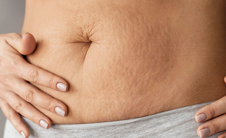 Skin Laxity (Abdomen, Arms, Knees) - The Nimmo Clinic - Aesthetic ...