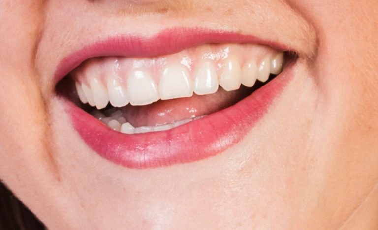 Gummy Smile - The Nimmo Clinic - Aesthetic Clinics In Surrey & Chelsea